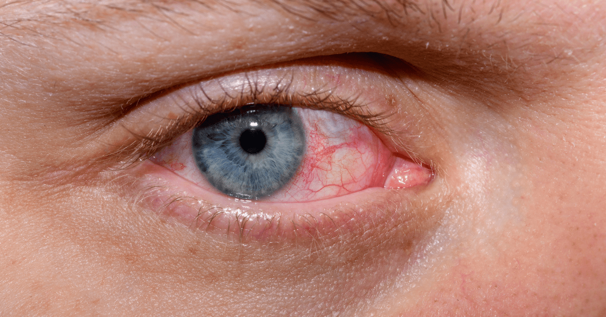 Can Dry Eyes Cause Retina Problems? | Retina Institute of Washington ...